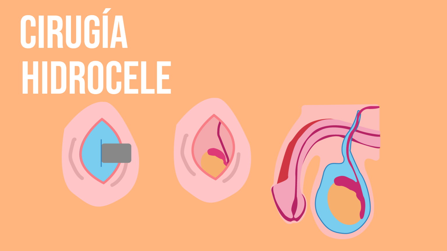 Cirugía hidrocele – Dr. Mario Doria