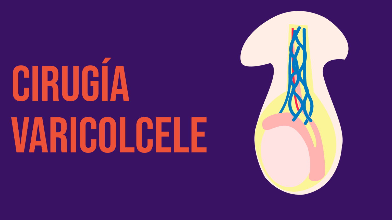 Cirugía varicocele – Dr. Mario Doria