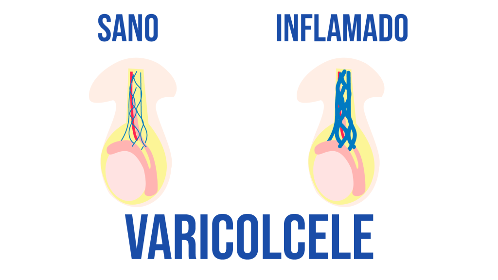 Varicocele – Dr. Mario Doria